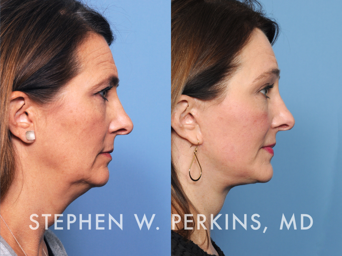 Dr. Stephen Perkins - Facial Plastic Surgeon, Indianapolis