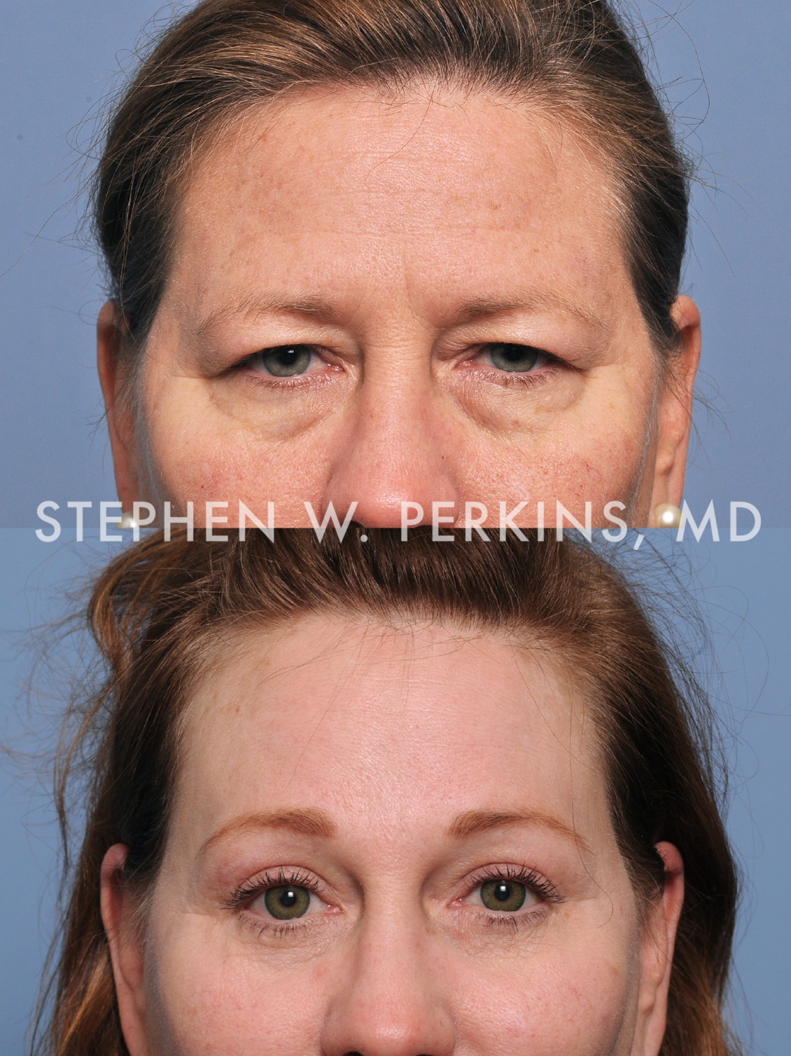 Forehead / Eyebrow Lift – Indianapolis Plastic Surgeons | Dr. Stephen ...